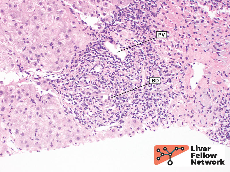 Pathology Pearls: Acute Cellular Rejection | AASLD