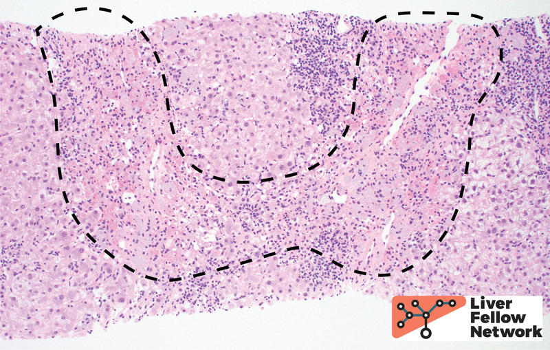 Pathology Pearls: Acute Cellular Rejection | AASLD