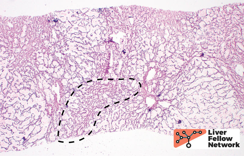 Pathology Pearls: Acute Cellular Rejection | AASLD