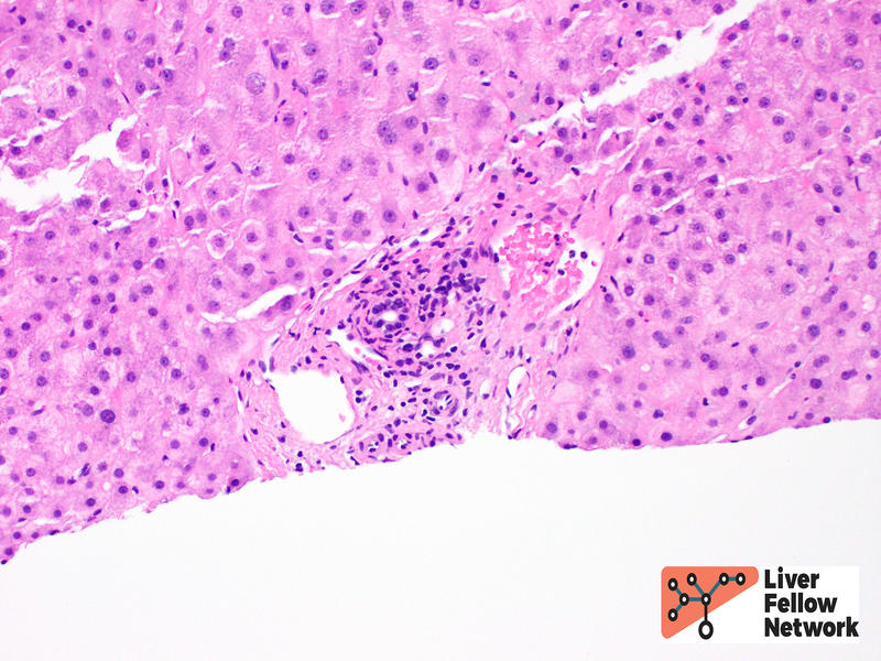 Pathology Pearls: Acute Cellular Rejection | AASLD