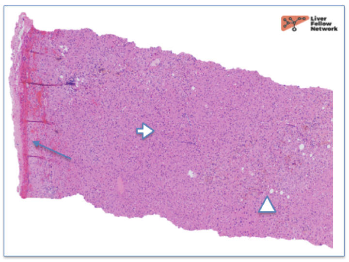 Pathology Pearls: Hepatocellular adenoma | AASLD