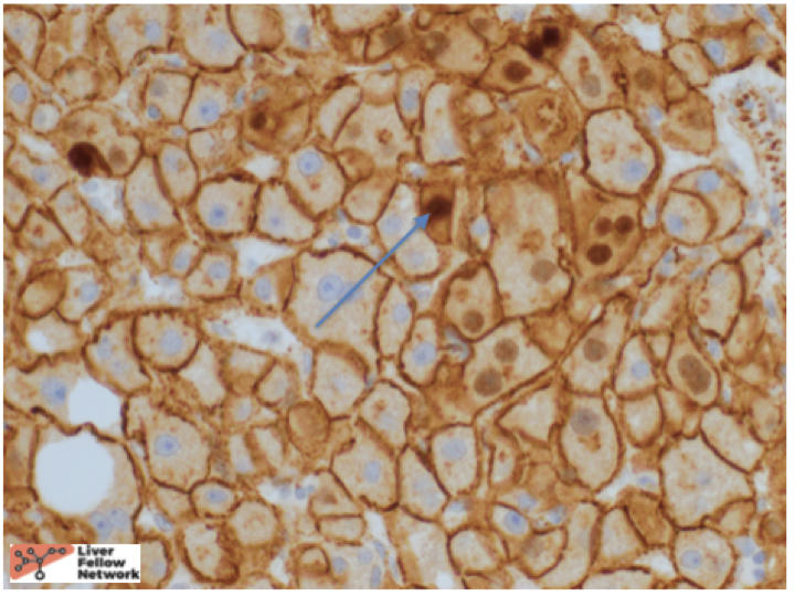 Pathology Pearls: Hepatocellular adenoma | AASLD