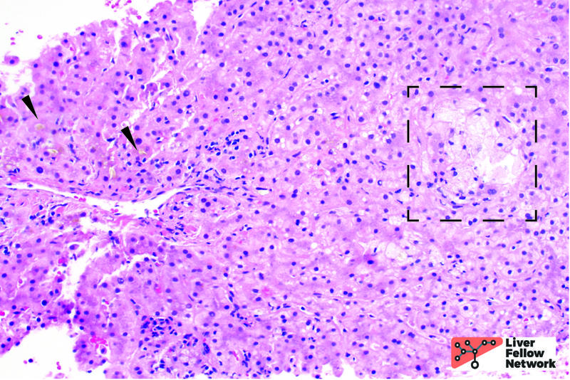 Pathology Pearls: Chronic Cellular Rejection | AASLD