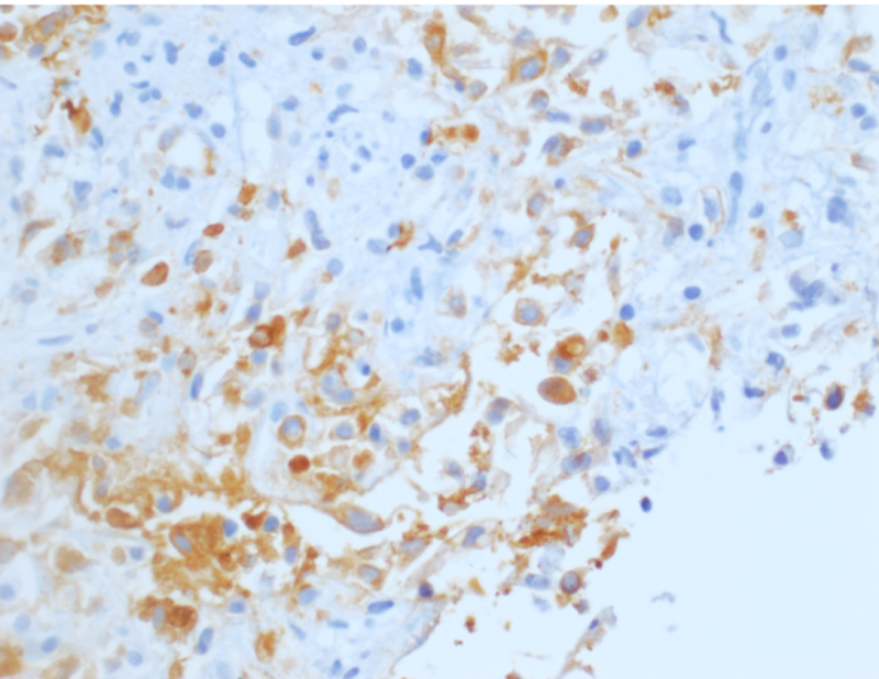 Pathology Pearls: Intrahepatic Cholangiocarcinoma | AASLD
