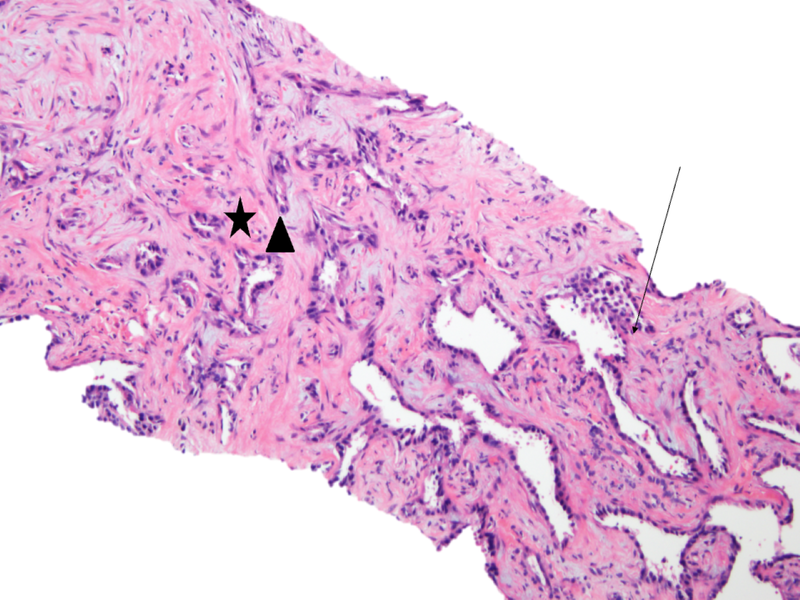 Pathology Pearls: Intrahepatic Cholangiocarcinoma | AASLD