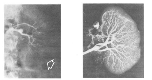 Why are patients with cirrhosis susceptible to hepatorenal syndrome ...
