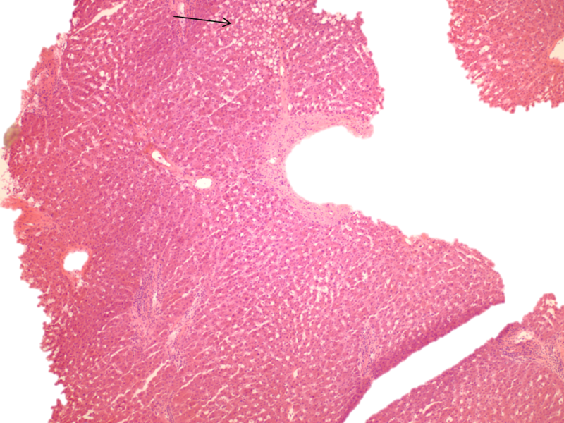 Pathology Pearls: Evaluation of Donor Liver Biopsies | AASLD