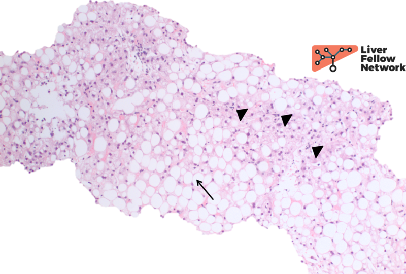 Pathology Pearls Wilson Disease Aasld