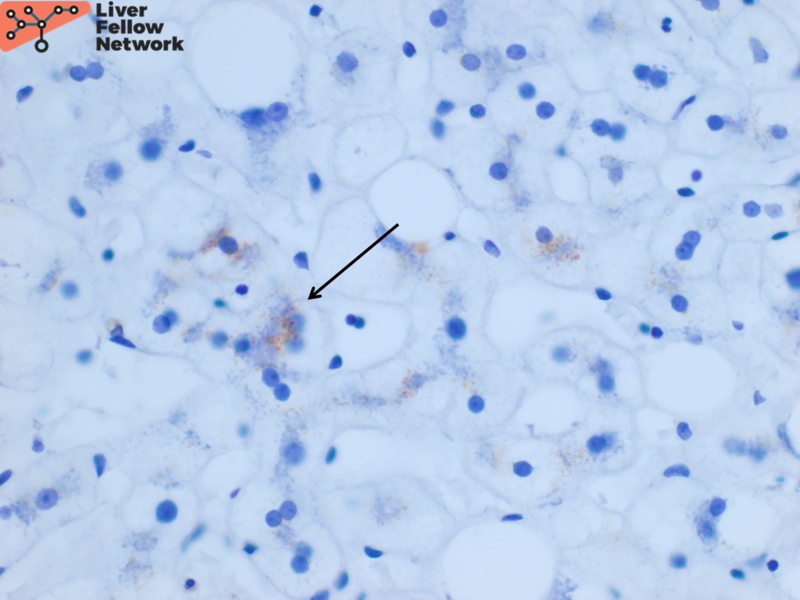 Pathology Pearls: Wilson Disease | AASLD