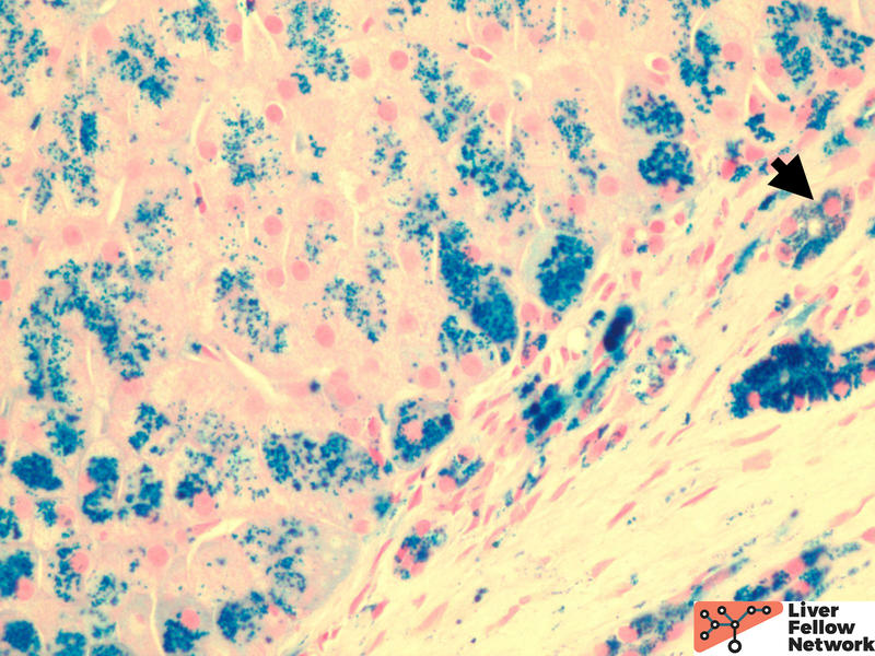 PATHOLOGY PEARLS: HEREDITARY HEMOCHROMATOSIS | AASLD