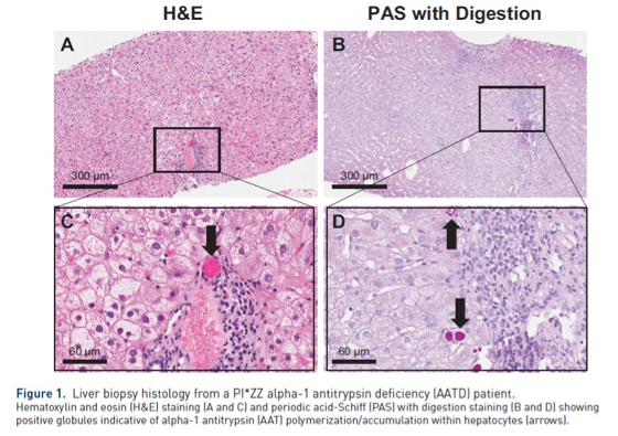 Why does alpha-1 antitrypsin deficiency cause liver disease? | AASLD