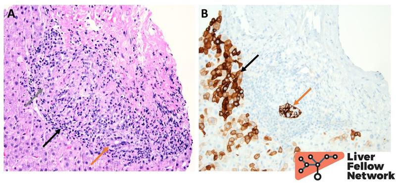Pathology Pearls Granulomatous Liver Diseases Aasld