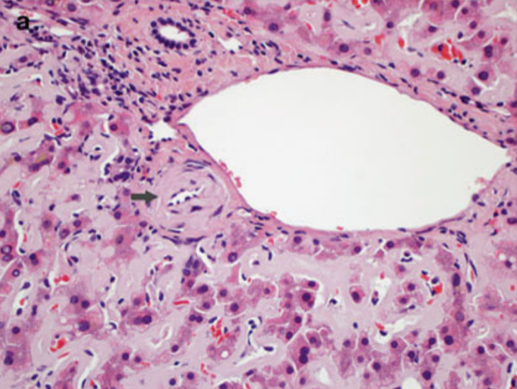 Pathology Pearls: Amyloidosis | AASLD