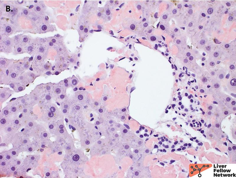 Pathology Pearls: Amyloidosis | AASLD
