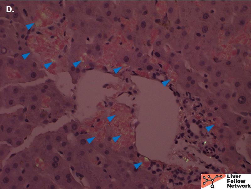 Pathology Pearls: Amyloidosis | AASLD