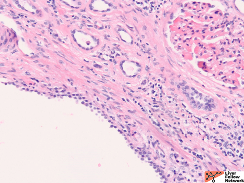 Pathology Pearls: Autosomal dominant polycystic kidney disease ...