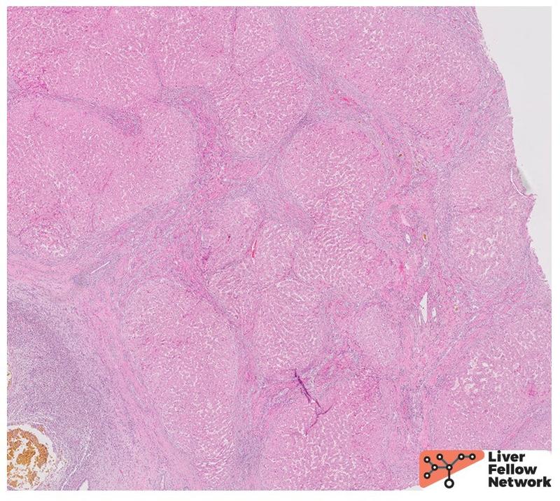 Pathology Pearls: The 3 C's - Congenital Hepatic Fibrosis, Caroli ...