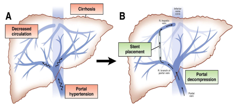 Why does hepatic encephalopathy develop after transjugular intrahepatic ...
