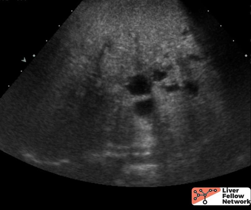 Pathology Pearls: The 3 C's - Congenital Hepatic Fibrosis, Caroli ...